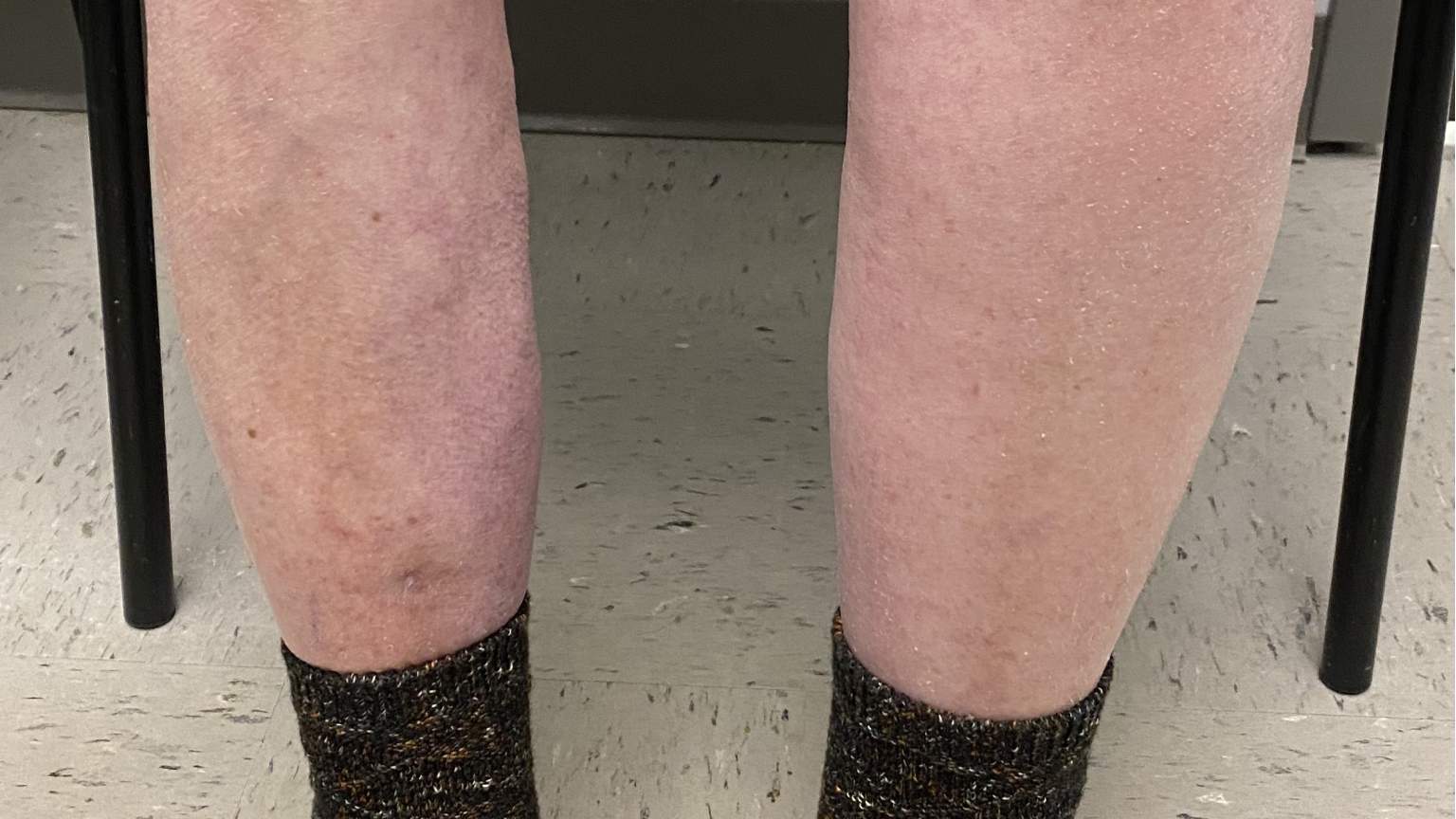 Deep Vein Thrombosis (DVT) - Access Care Vascular - Buffalo, NY