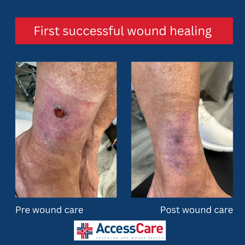 First successful wound healed!!!! - Access Care Vascular - Buffalo, NY